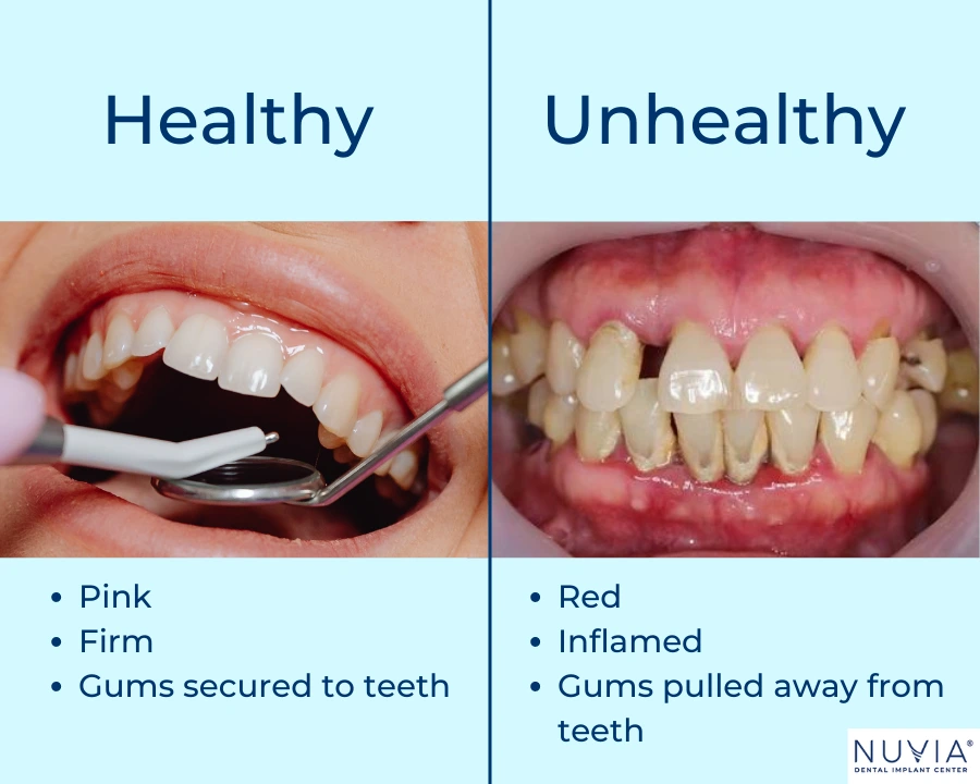 Can Dental Implants Be A Solution For Periodontal Disease?